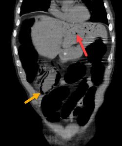 Pneumatosis Intestinalis - Ischemic Bowel Disease | Radiology For Beginners
