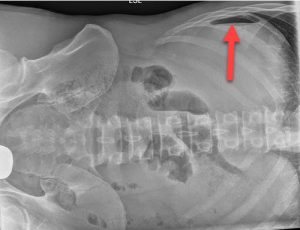Pneumoperitoneum - Radiology For Beginners by Dr. Samuel Kobba
