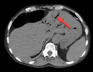 Pneumatosis Intestinalis - Ischemic Bowel Disease | Radiology For Beginners