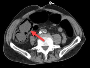 Pneumatosis Intestinalis - Ischemic Bowel Disease | Radiology For Beginners
