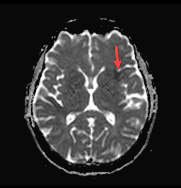 Middle Cerebral Artery Stroke - Radiology For Beginners by Dr. Samuel Kobba