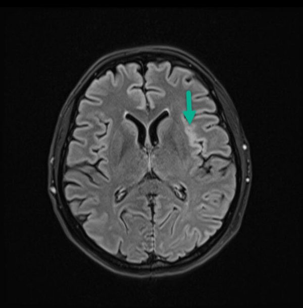 Middle Cerebral Artery Stroke - Radiology For Beginners by Dr. Samuel Kobba