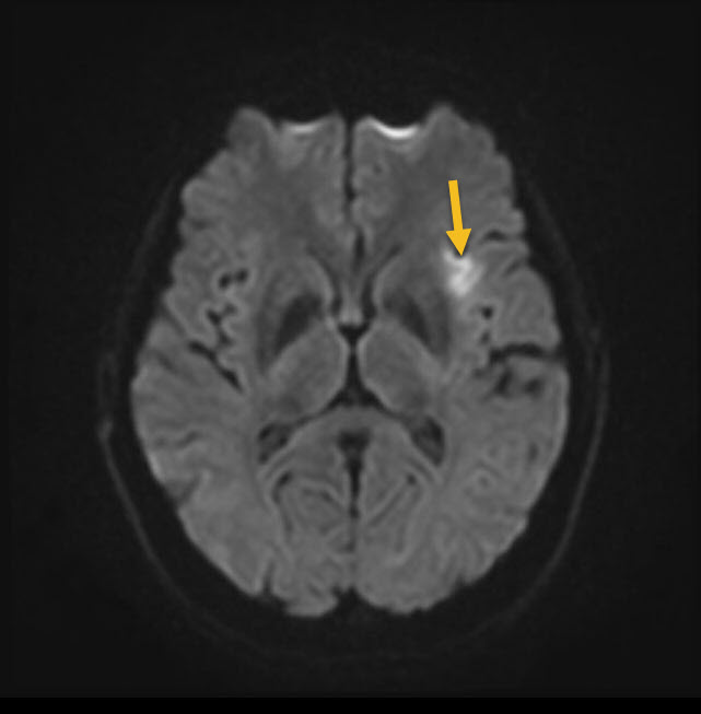 Middle Cerebral Artery Stroke - Radiology For Beginners by Dr. Samuel Kobba