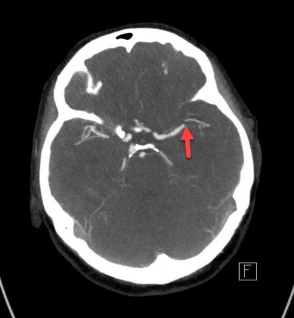 Middle Cerebral Artery Stroke - Radiology For Beginners by Dr. Samuel Kobba