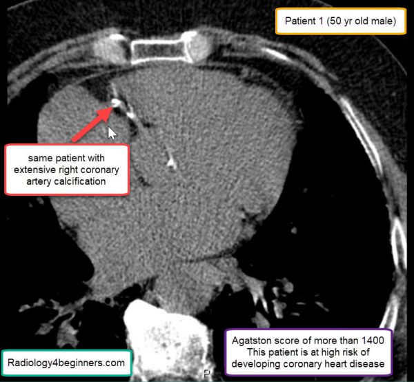 Coronary Calcium Scoring – Radiology For Beginners by Dr. med. Samuel Kobba