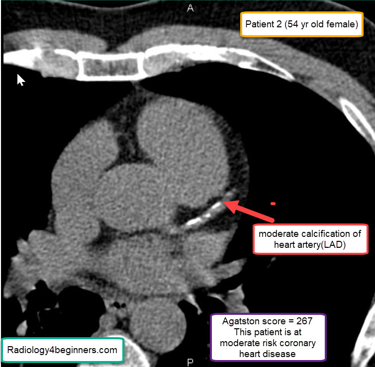 Coronary Calcium Scoring - Radiology For Beginners by Dr. Samuel Kobba