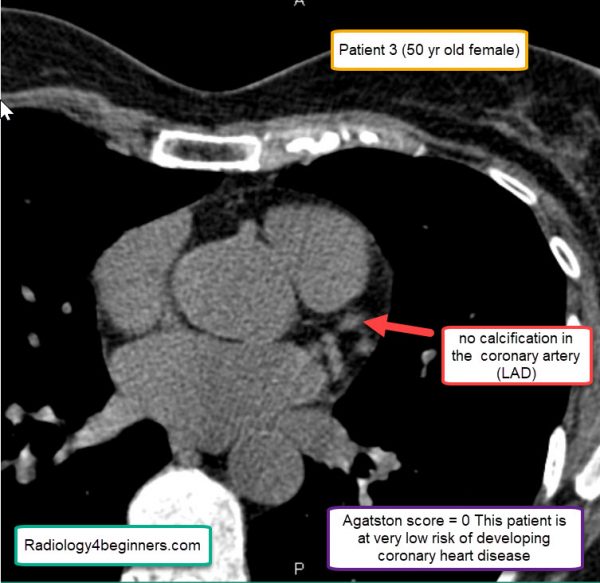 Coronary Calcium Scoring - Radiology For Beginners by Dr. Samuel Kobba