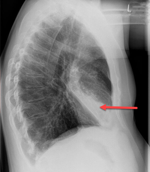 Pneumonia - Radiology For Beginners by Dr. Samuel Kobba