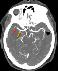 MCA occlusion stroke, MCA Segments Radiology | Radiology For Beginners