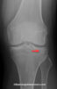 SegondFracture Radiology - ACL injury | Radiology For Beginners