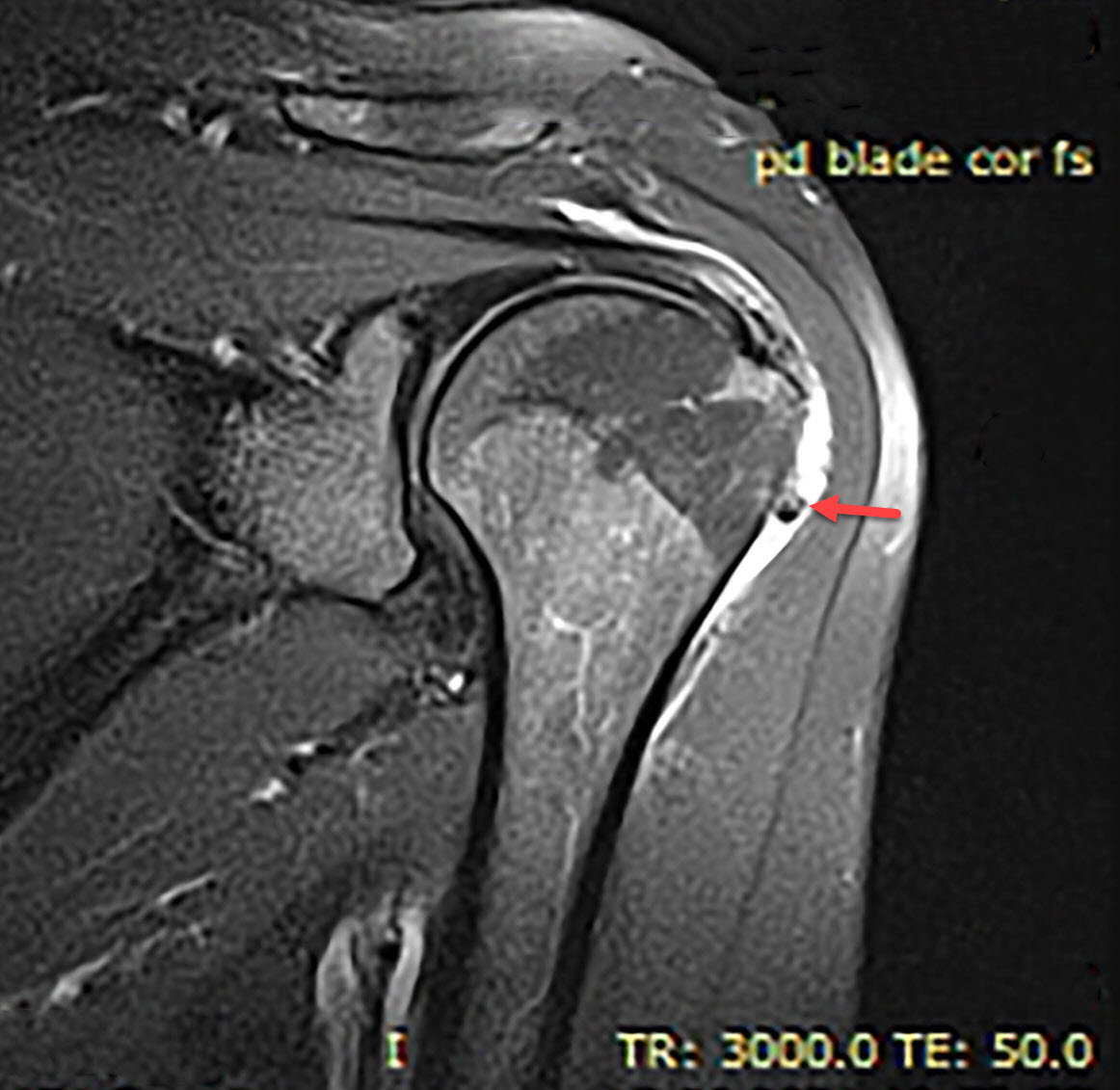 Calcific tendinosis - Radiology For Beginners by Dr. Samuel Kobba