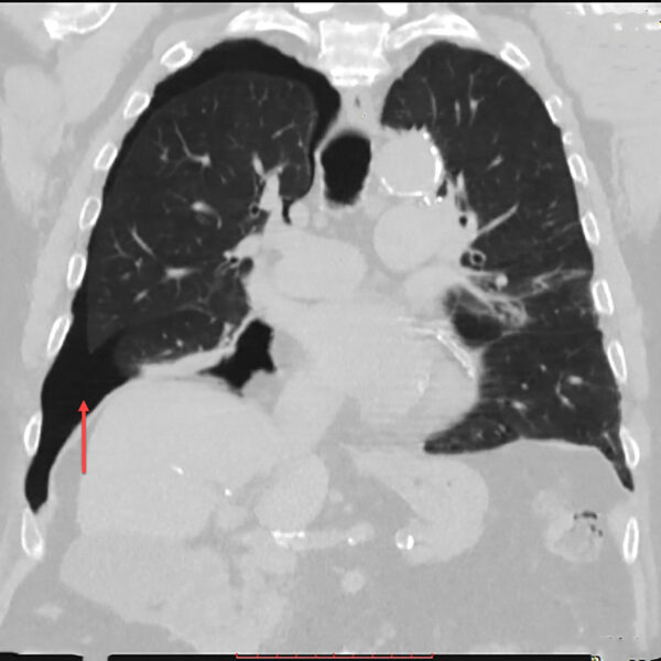 Pneumothorax - Radiology For Beginners by Dr. Samuel Kobba