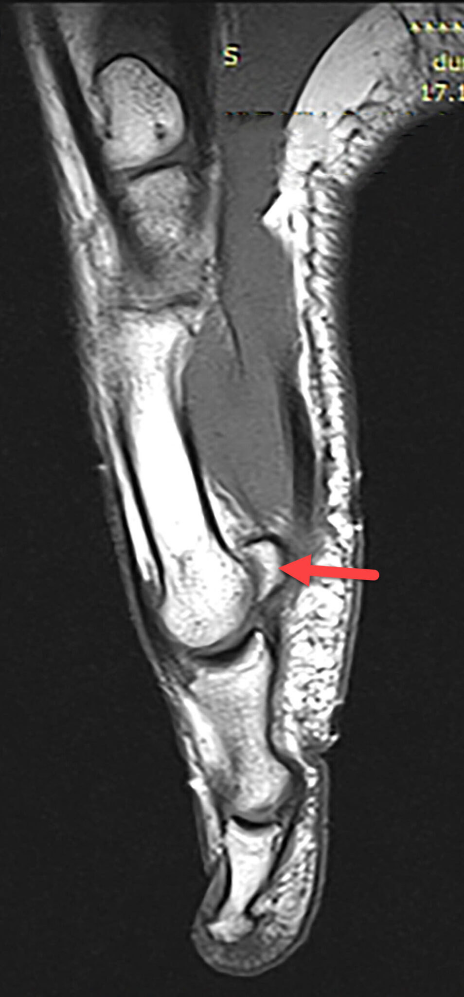 Sesamoiditis - Radiology For Beginners by Dr. Samuel Kobba
