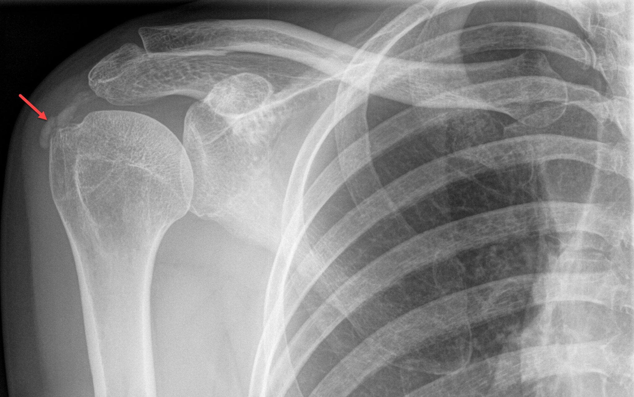 Calcific tendinosis - Radiology For Beginners by Dr. Samuel Kobba