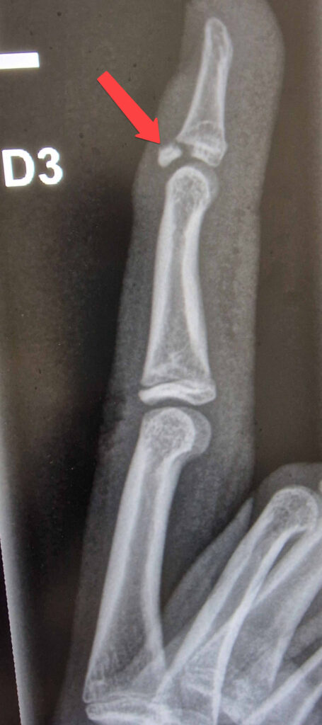 Avulsion Fracture of Distal Insertion of Common Extensor Tendon ...